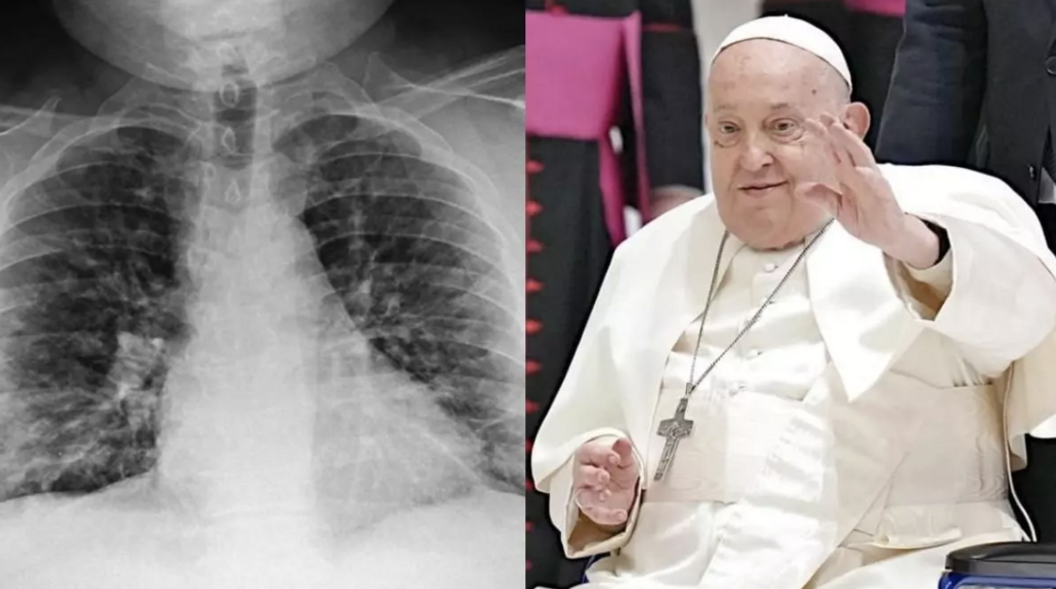 El Papa Francisco sufre una neumonía bilateral y sigue con un cuadro clínico complejo - Diario ...